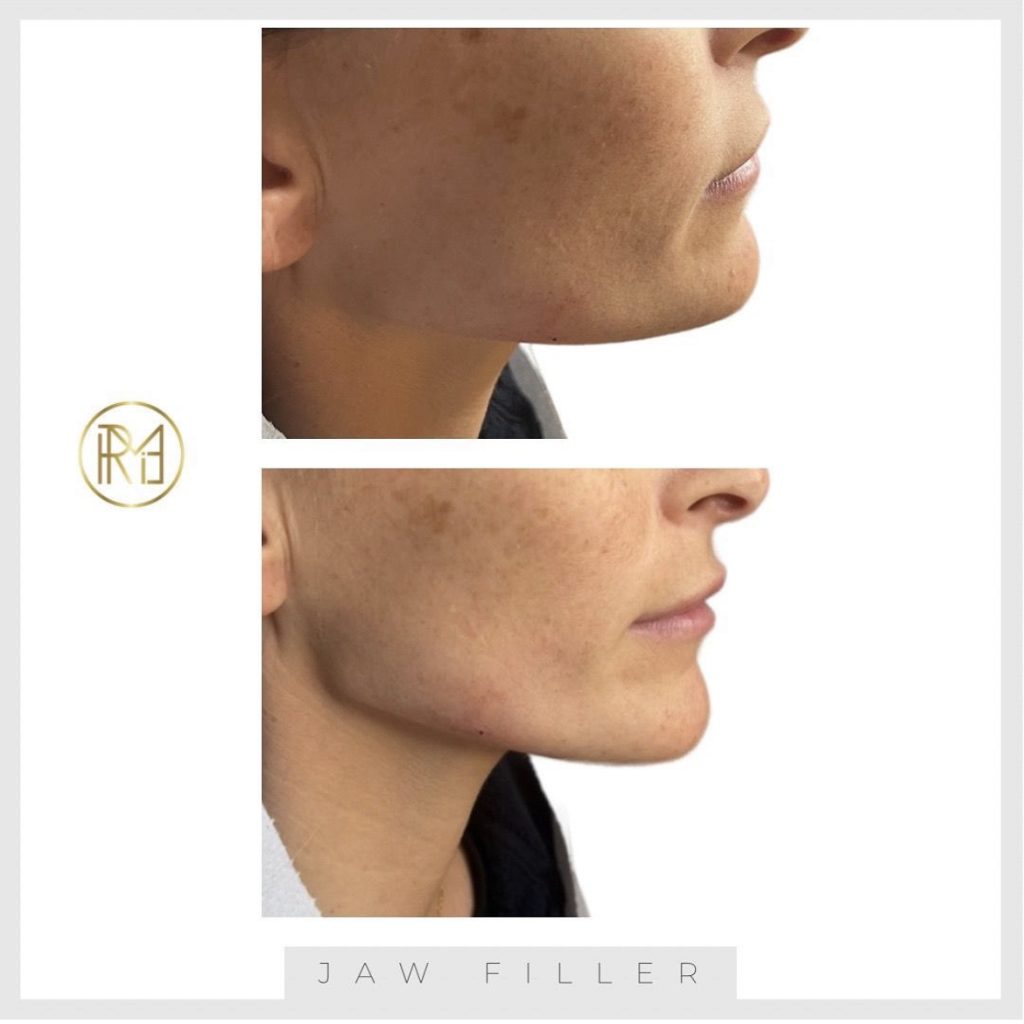 Jaw fillerTreatment - Prime Beauty & Aesthetics - Manchester