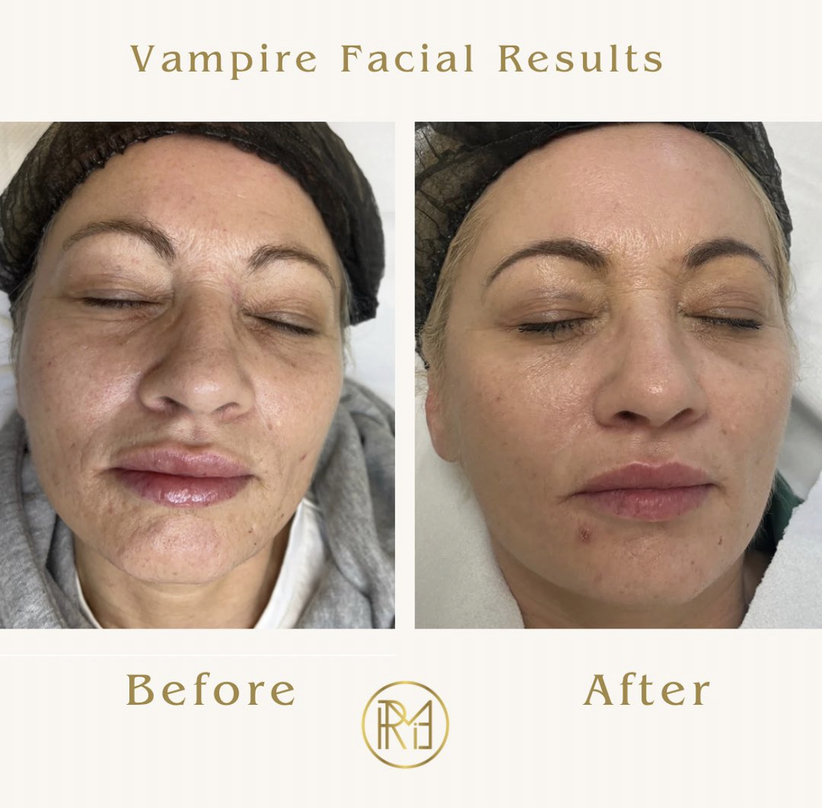 PRP/ Vampire FacialTreatment - Prime Beauty & Aesthetics - Manchester